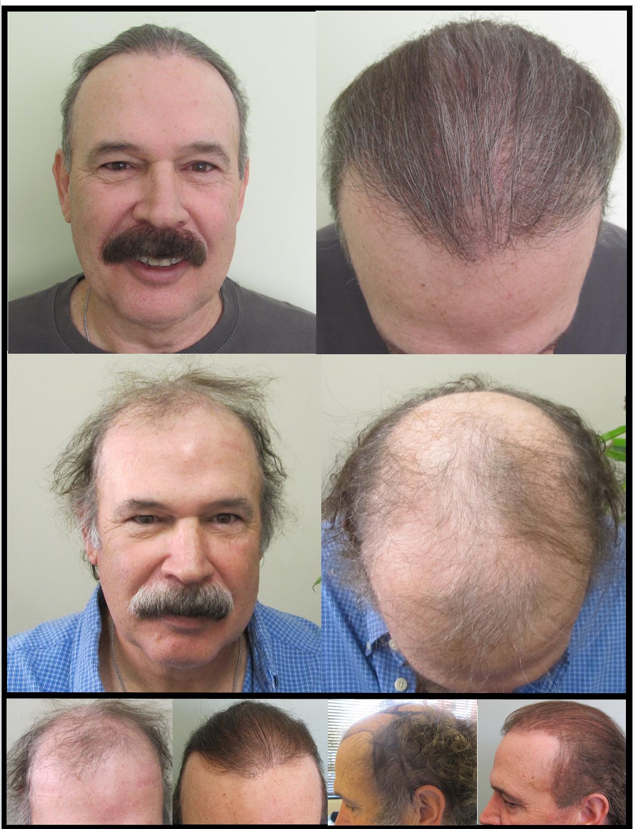 Patient 11 - My Hair MD