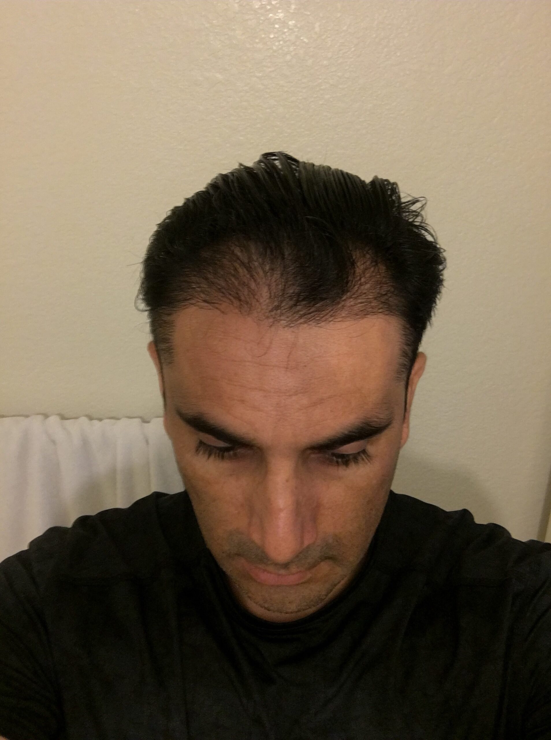 Patient 13 - My Hair MD